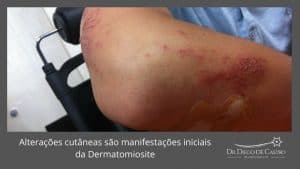 Dermatomiosite - Inflamação Muscular e Cutânea - Dr Diego De Castro