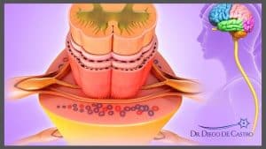 Mielite Transversa - Dr Diego De Castro Neurologista